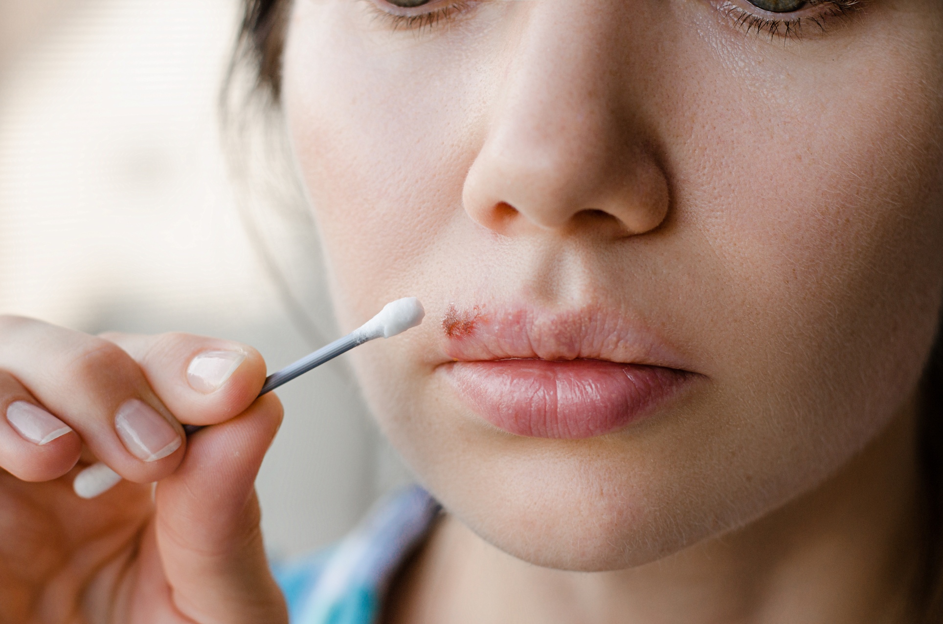 Aprenda Como Tratar A Sua Herpes Labial Dr Santo Andr Aprenda Como Tratar A Sua Herpes Labial Dr Santo Andr